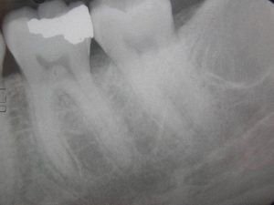 Reversible Pulpitis – Hyperemia – Hyperactive pulpalgia